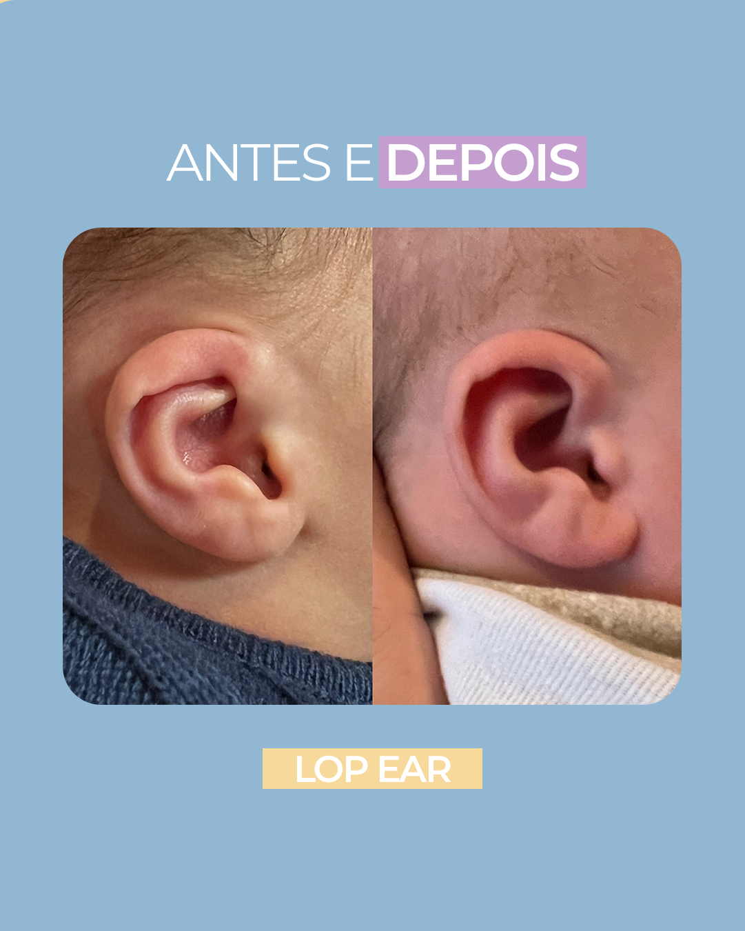 Lop ear: o que é e quais as causas? - Dr. Rafael Zatz